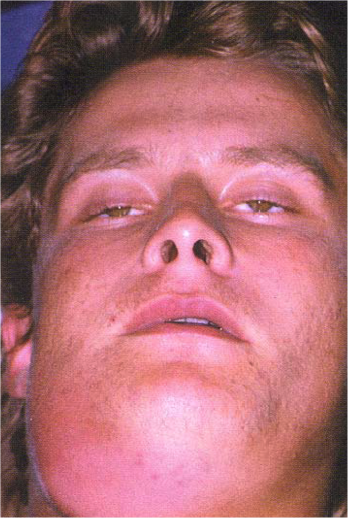 Флегмона челюстно-лицевой области — Стоматология